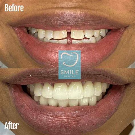 Overjet Before After Pictures At Smile Dental Turkey