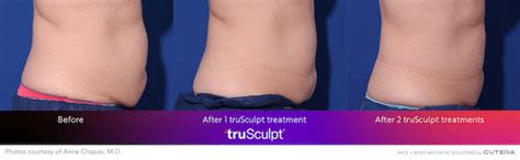 Trusculpt Id Nyc Customized Body Contouring Treatments