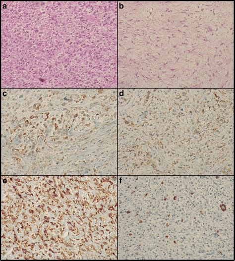 Histological Features Of The Sarcoma Magnification 200x The Tumor