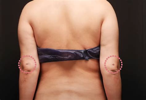 Liposuction Scars How To Minimize Scars