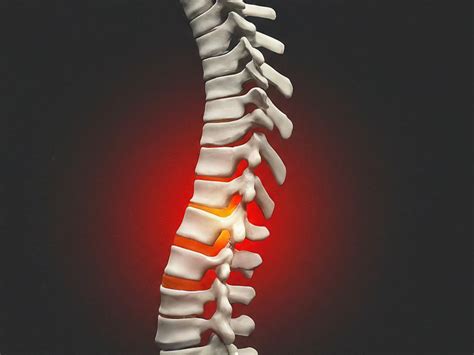 Bertolotti Syndrome Understanding A Hidden Cause Of Lower Back Pain