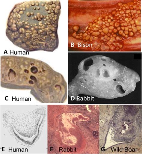 图示评论性回顾：继发性肺结核的病理 搜狐大视野 搜狐新闻