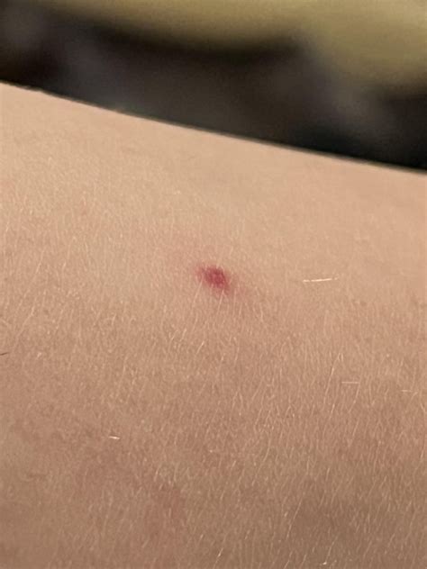 Anyone Have Any Idea If This Is A Bite Or A Pimple Rbugbite