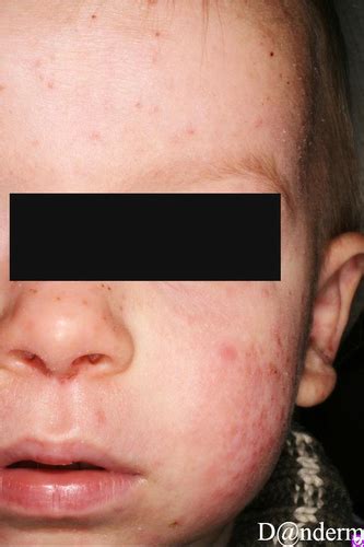 Dermatology Flashcards Quizlet Dermatology Flashcards Quizlet