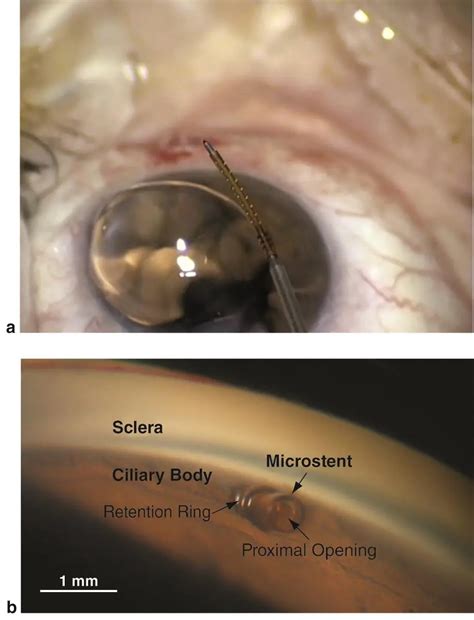 Cypass Micro Stent Alcon American Academy Of Ophthalmology
