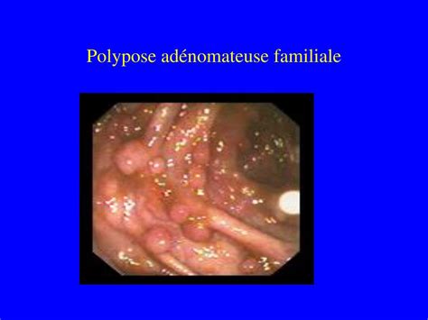 Ppt Polypes Recto Coliques Powerpoint Presentation Free Download