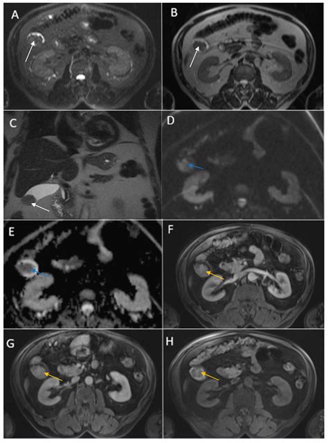 The Many Hidden Faces Of Gallbladder Carcinoma On Ct And Mri Imaging