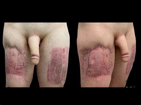 Phalloplasty Before And After Photos Drew Marano Md And Jonathan Keith Phalloplasty Before And After Photos Drew Marano Md And Jonathan Keith