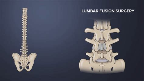 Postoperative Care For Spinal Fusion Surgery