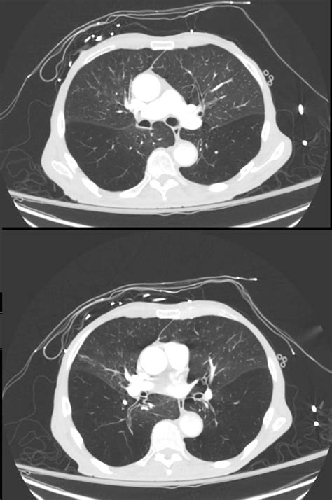 Faces Of Emphysema Panlobular The Common Vein