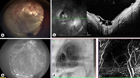 Multimodal Imaging Of Large Optic Disc Coloboma A Report Of Three