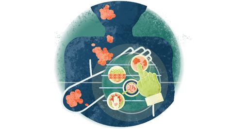 Atopic Dermatitis Medical Journeys Medpage Today