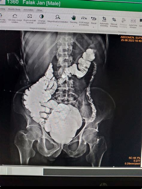 Distal Loopogram In Amh Gilgit Hussain Ali