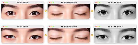 일퍼센트성형외과의원 올포원 눈성형
