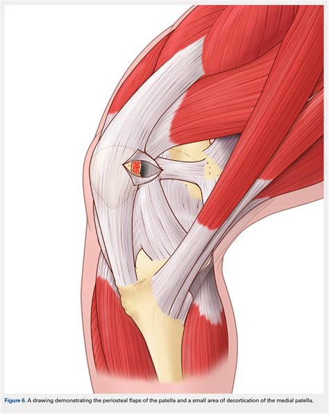 The Anatomy Of The Medial Patellofemoral Ligament