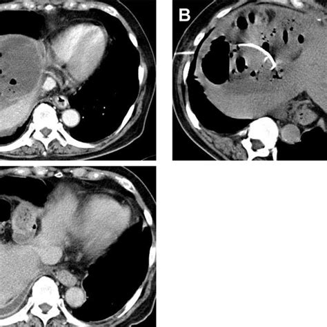 Pdf Subphrenic Abscess Due To Clostridium Perfringens After Hepatic Resection For