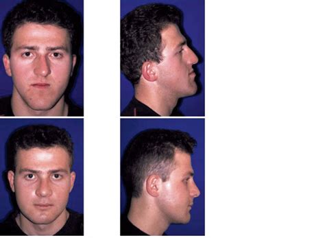 Advancement And Intrusion Of The Maxilla Mandibular Setback Vertical