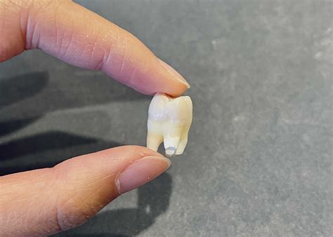 Senior Details The Gruesome Operation And Aftermath Of A Wisdom Tooth