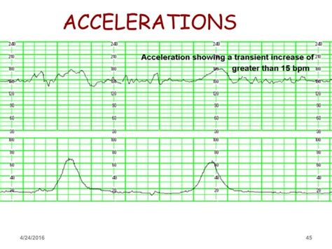 Cardiotocography Pptx Pregnancy Reproductive Health