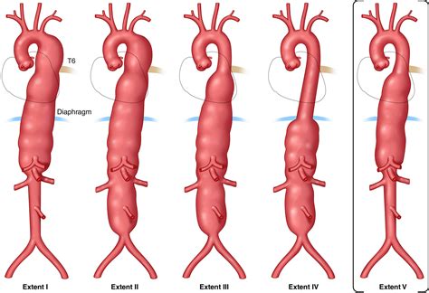 2022 Acc Aha Guideline For The Diagnosis And Management Of Aortic