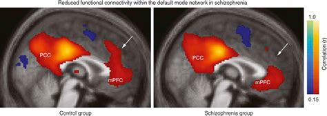 Psychosis And Schizophrenia Clinical Tree