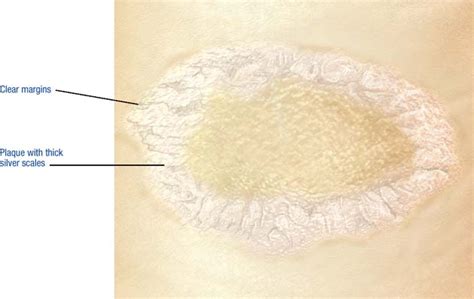 Psoriasis Atlas Of Pathophysiology 2 Edition