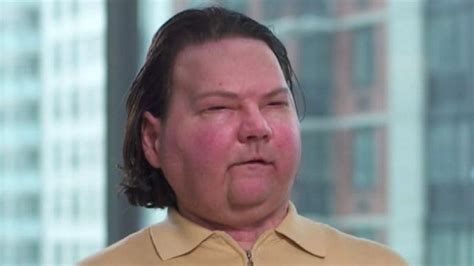 Primeiro Transplante Bem Sucedido De Rosto E Mãos A História De Joe