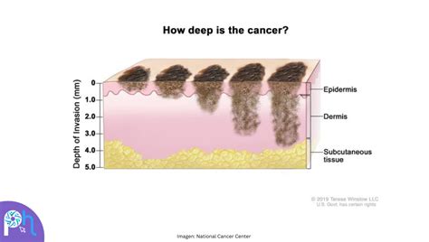 Cáncer De Piel El Tipo De Cáncer Más Común En Las Personas De Estados
