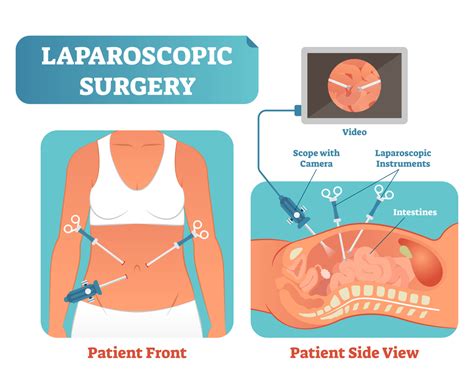 What To Expect With Laparoscopic Robotic Surgery For Abdominal Masses