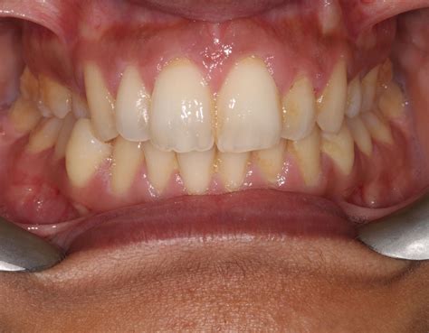 Spark Aligners From £100 Pm Interest Free Myodental