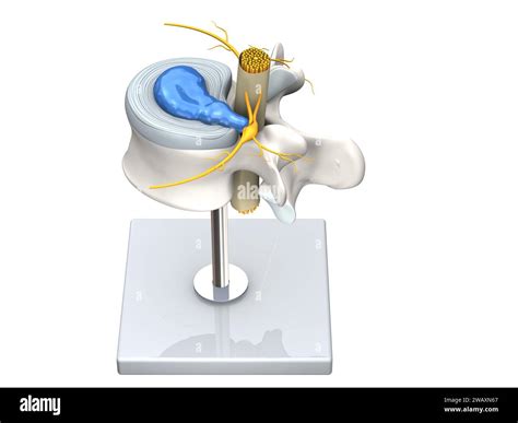 Illustration Showing Model Of A Herniated Disc Of The Lumbar Spine