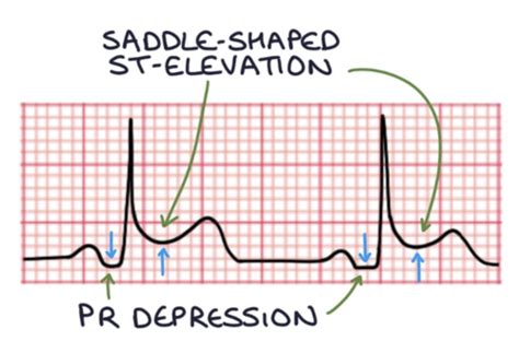 Pericarditis Flashcards Quizlet