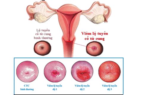 3 Levels Of Cervical Ectropion Vinmec