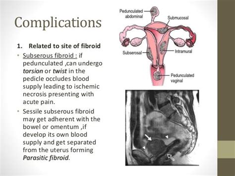 Uterine Fibroid Necrosis