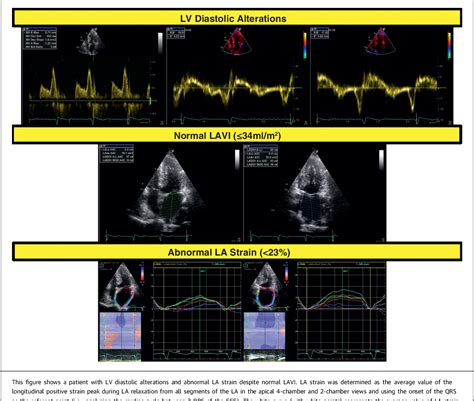 Left Ventricular Diastolic Dysfunction Semantic Scholar