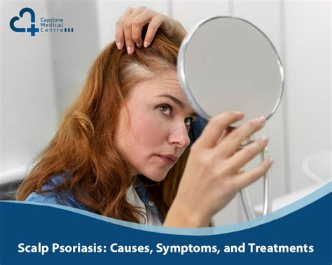 Scalp Psoriasis Causes Symptoms And Effective Treatments Capstone
