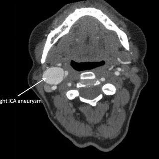 The Bone Window In The Ct Scan Of The Brain Shows The Carotid Canal On