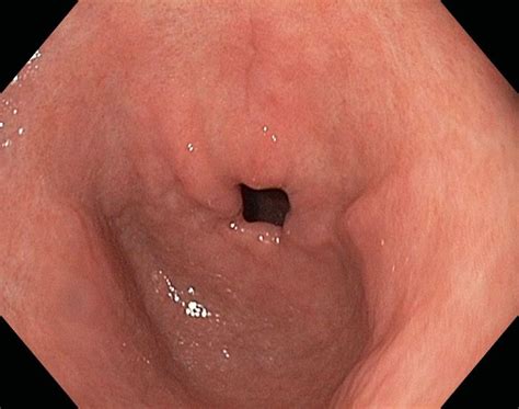 Normal Endoscopy Results