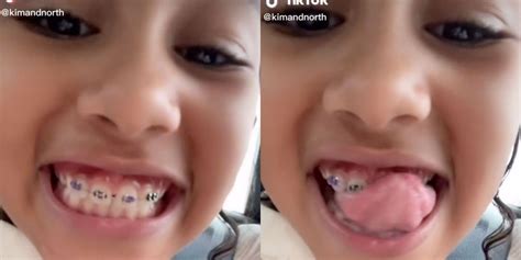 Tiktok Girl With Braces At Courtney Szeto Blog