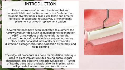 Ridge Split Techniques In Prosthodontics Enhancing Alveolar Ridge For
