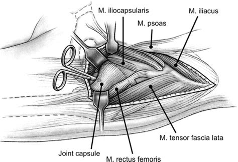 Surgical Technique Reverse Periacetabular Osteotomy Musculoskeletal Key