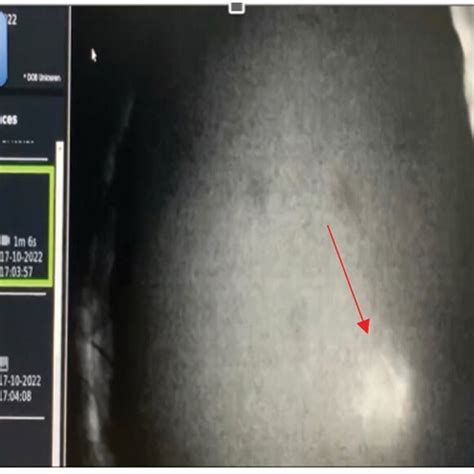 Immediate Post Op Indocyanine Green Icg Study Showed Poor Dye Uptake