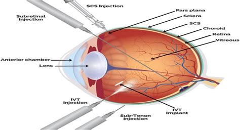 Thomas Ciulla Md Mba On Linkedin Suprachoroidal Space Injection