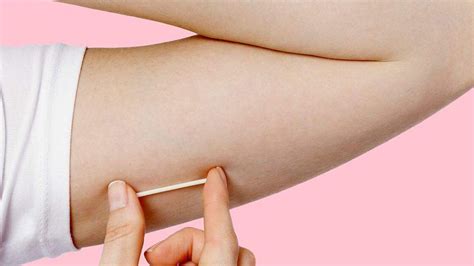 Como Funciona El Implante Subdermico Diario Del Sur Noticias
