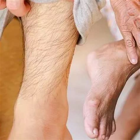 High Cholesterol Symptoms