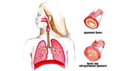 Признаки бронхита, симптомы, лечение. Профилактика пневмонии