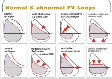 Flow Volume Loops Flashcards Quizlet