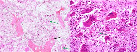 Right Hemipelvis Tumor And Right Above Knee Amputation Stump Pathology