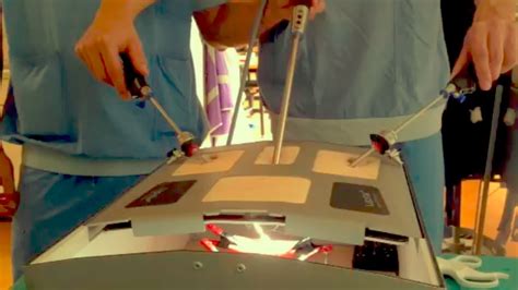 Laparoscopic Surgery Bidirectional Stratafix Hepaticojejunostomy