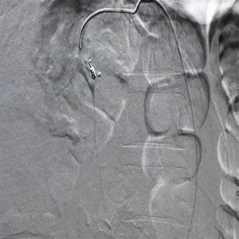 Selective Renal Artery Angiogram Showed Evidence Of Contrast